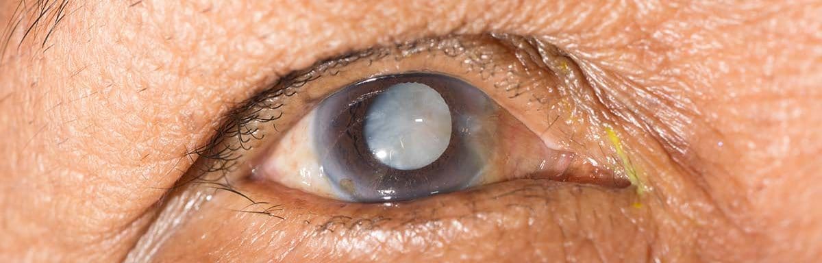 cataracts elderly man - Sight Eye Clinic